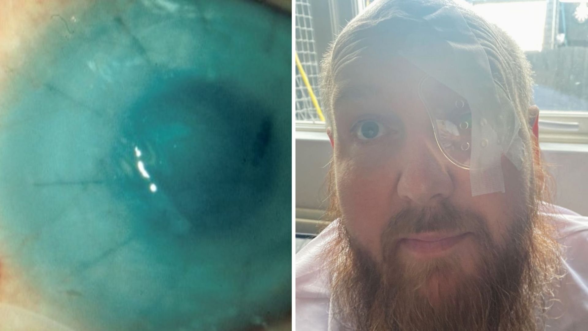 Acid attack victim reveals how donated placenta saved his eye - Tech ...